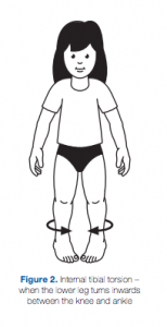 The One Easy & Simple Solution For In-toeing: The Gait Plate ...