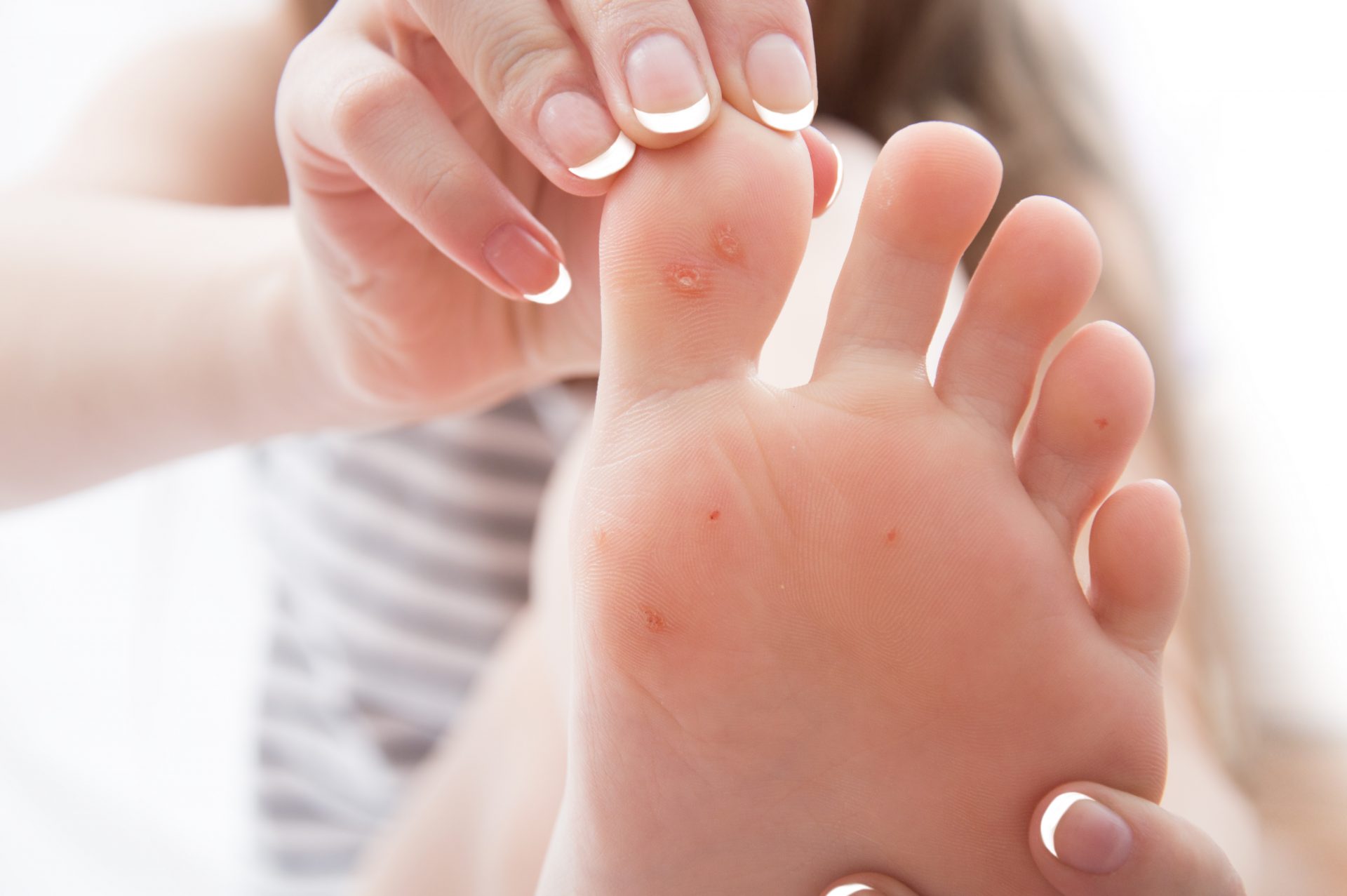 Warts on Feet, Veruccas, Plantar Warts | Masterton Foot Clinic, NZ