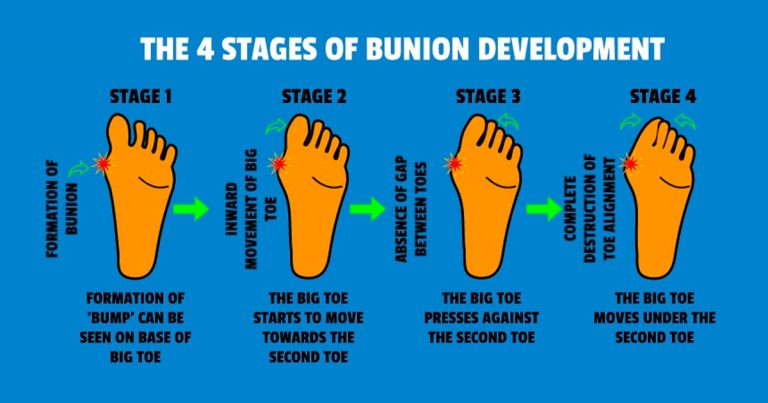 Bunions - Masterton Foot Clinic