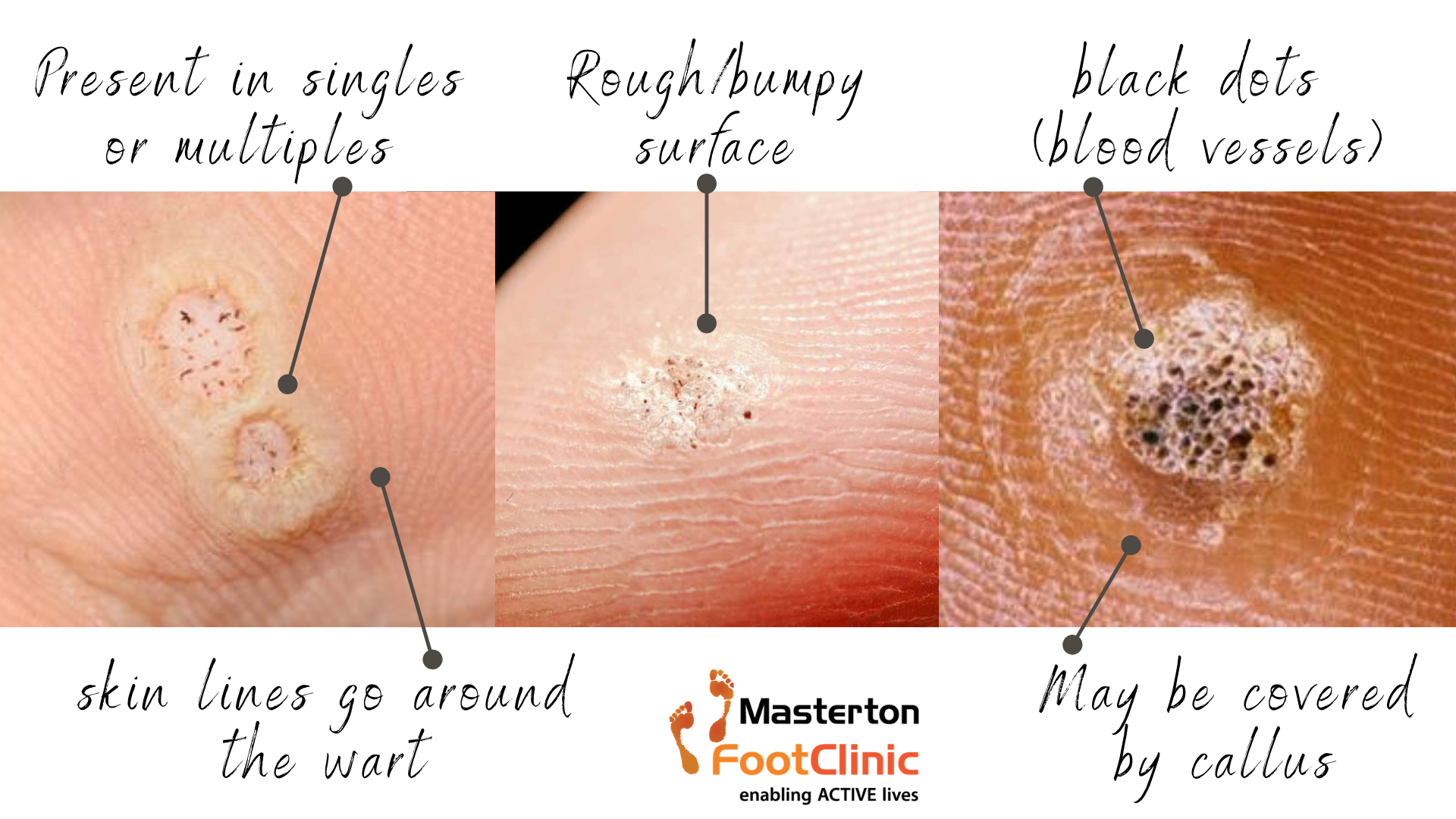 Why Kids Pick Up Warts On Their Feet At School - Masterton Foot Clinic