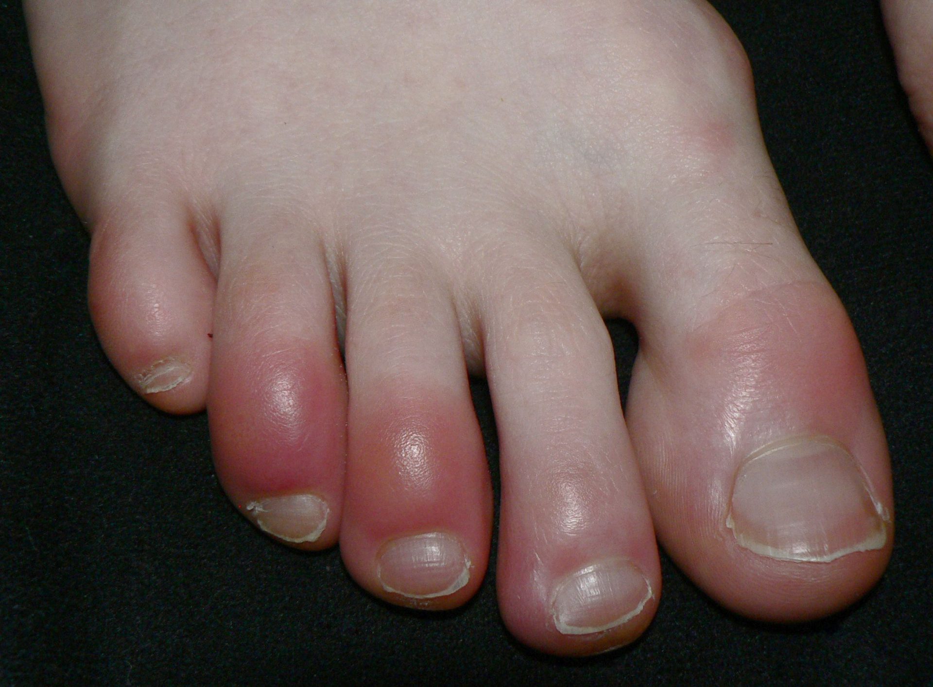 Chilblains - Masterton Foot Clinic