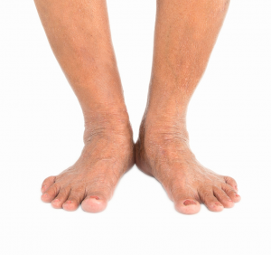 In-Toeing & Out-Toeing - Masterton Foot Clinic