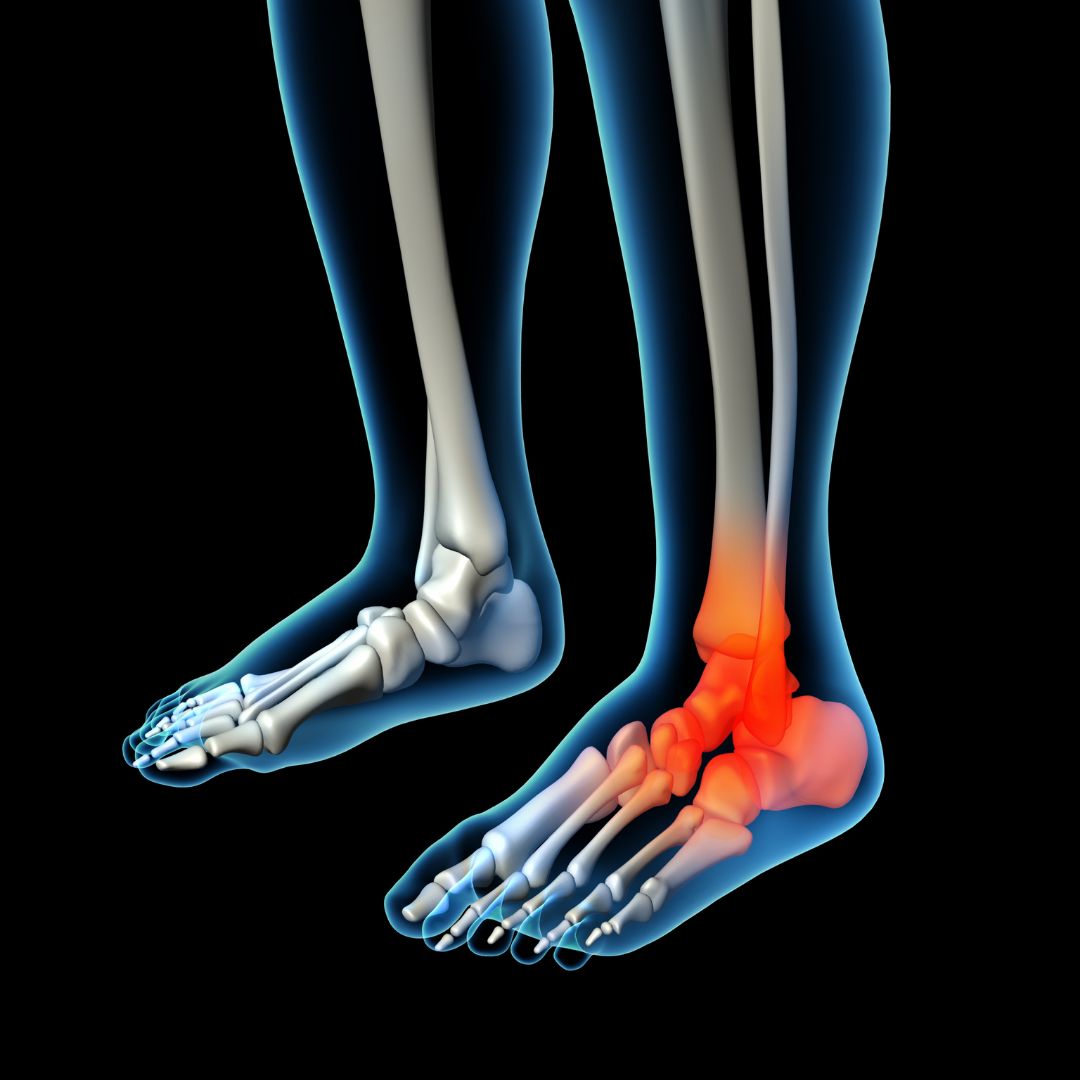 What’s Causing The Pain On The Outside Of My Foot? - Masterton Foot Clinic