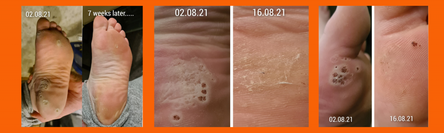 Warts on Feet, Veruccas, Plantar Warts | Masterton Foot Clinic, NZ