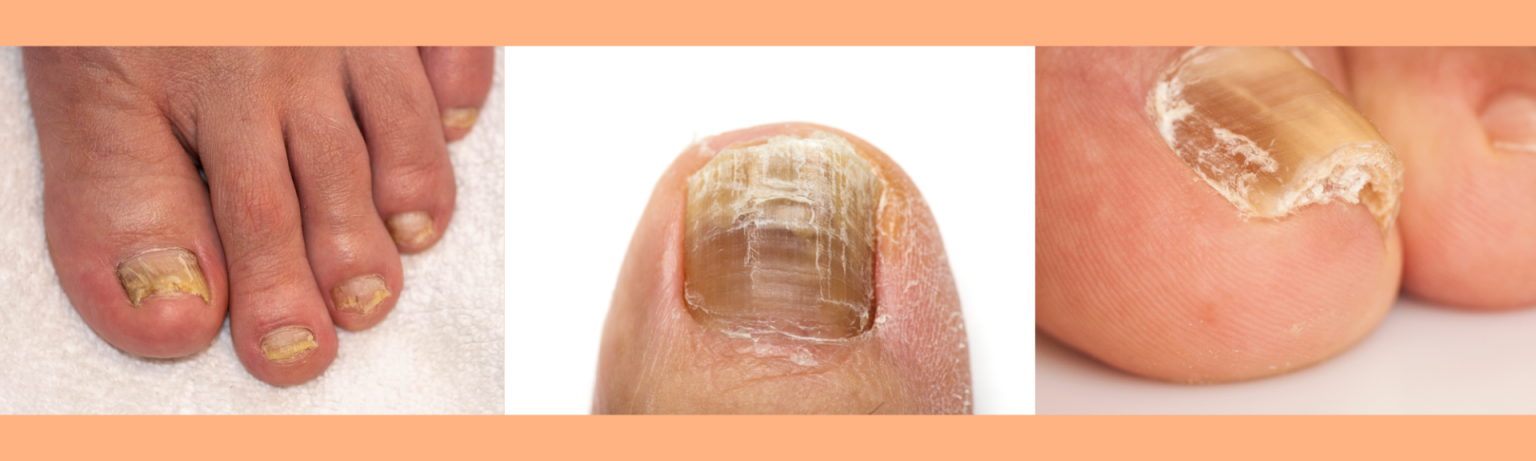 How Can I Stop My Toenails From Growing Thicker? - Masterton Foot Clinic