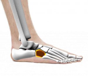 Cuboid Syndrome - Masterton Foot Clinic