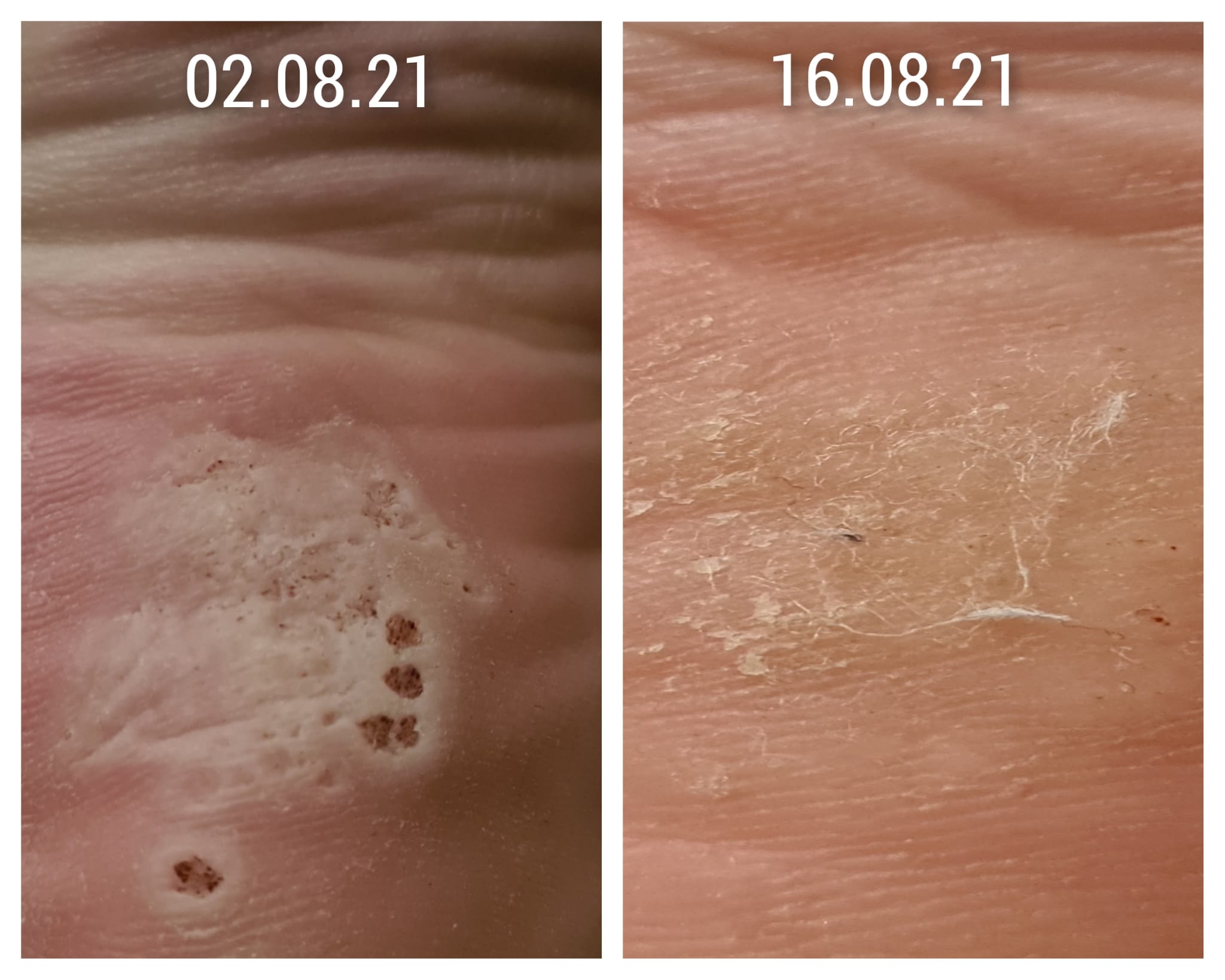 Case Study: Successfully Treating A Foot Covered In Plantar Warts ...