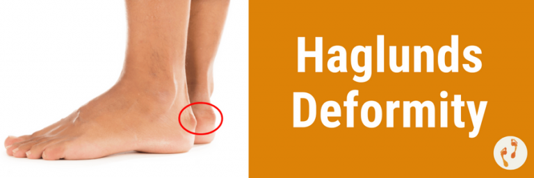 Haglund’s Deformity - Masterton Foot Clinic