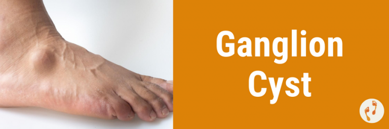 Ganglion Cyst - Masterton Foot Clinic