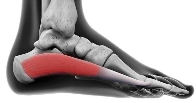 Abductor Hallucis Tendinopathy - Masterton Foot Clinic