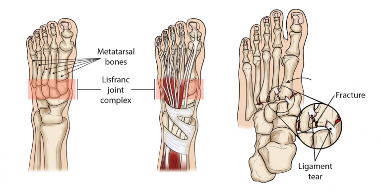Lisfranc Injury
